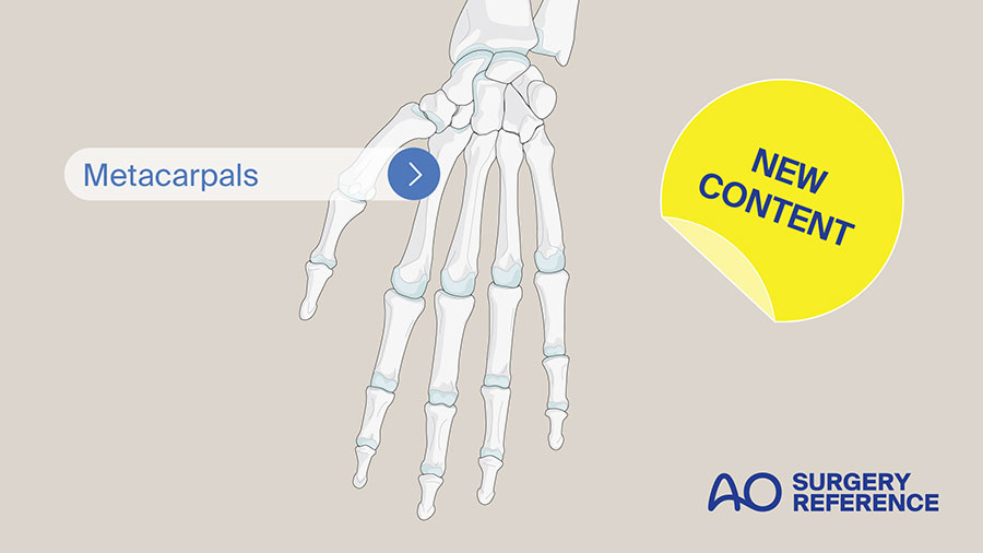 metacarpals bones