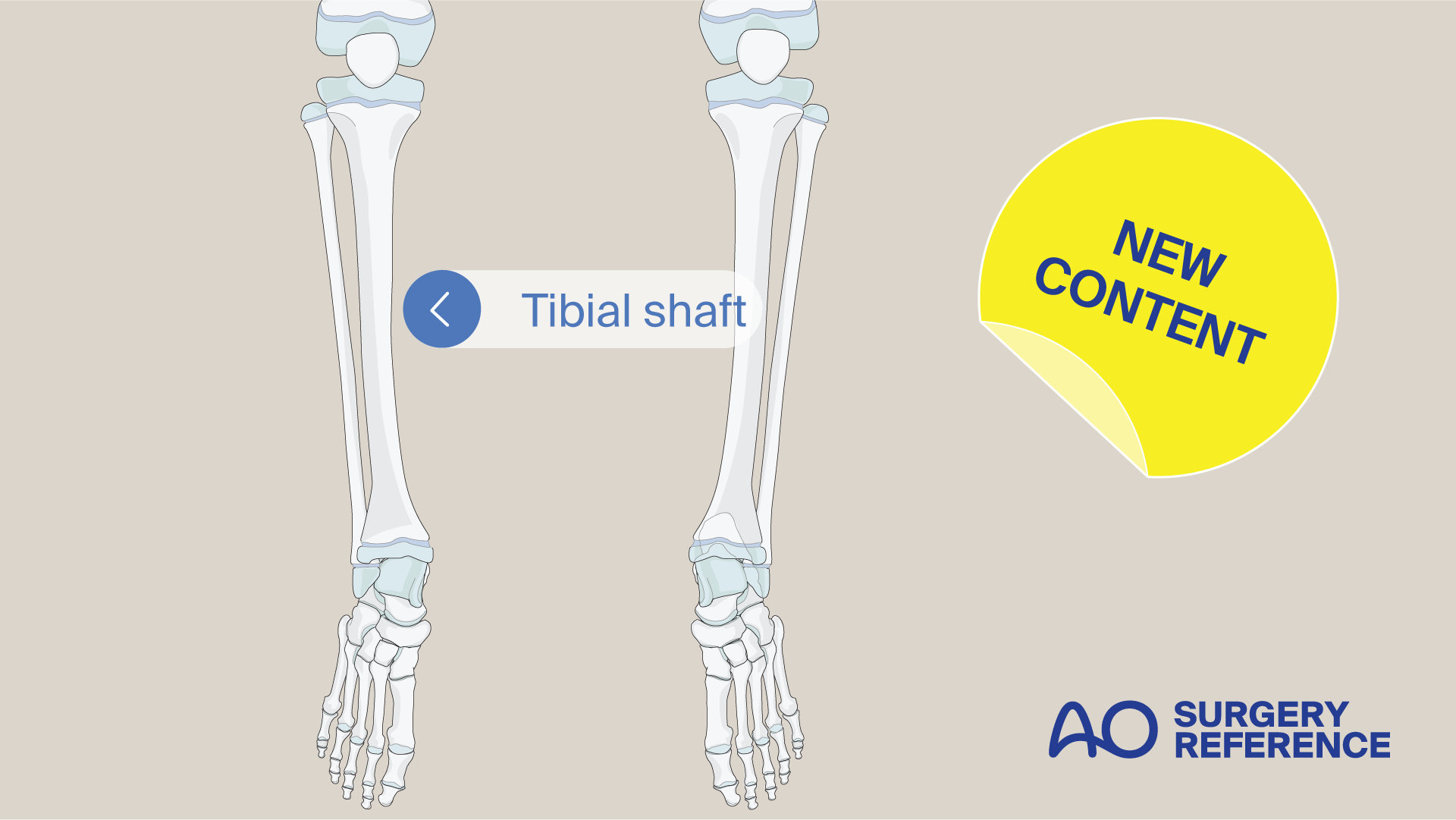 AO Surgery Reference update: New pediatric trauma content—Tibial shaft